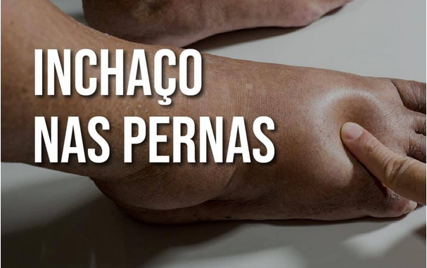 INCHAÇO NAS PERNAS – IMD – Instituto de Medicina Diagnóstica